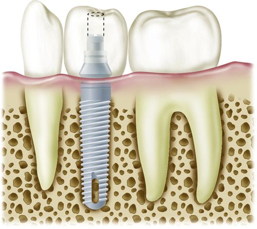 Dental Implants | Pocket Dentistry