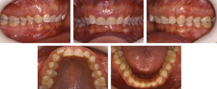 Mandibular tripod Advancement Of A Class II Division 2 Deepbite 
