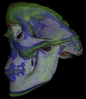 Evolution Of Class Iii Treatment In Orthodontics Pocket Dentistry