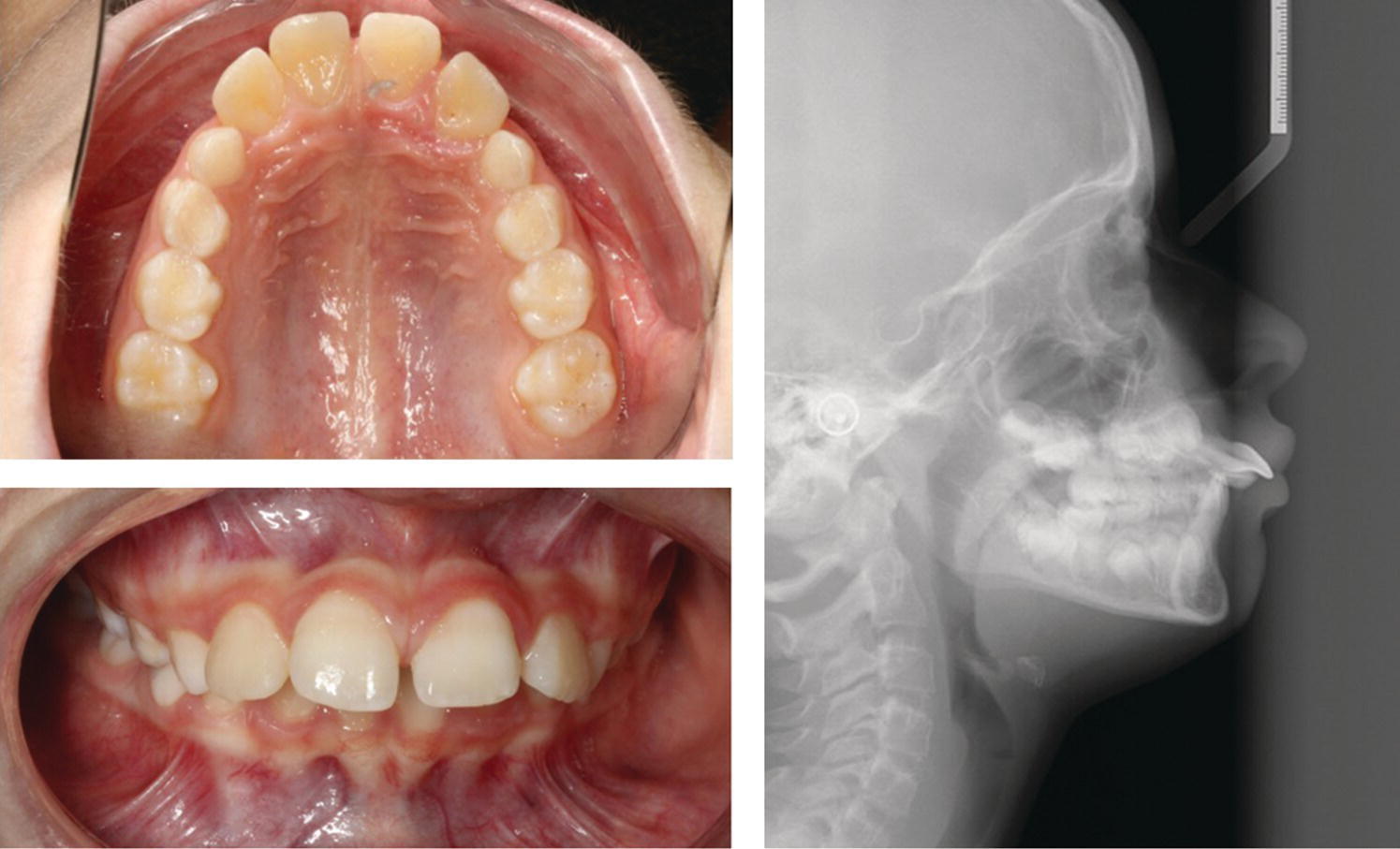 Treatment For Class Ii Malocclusion Pocket Dentistry