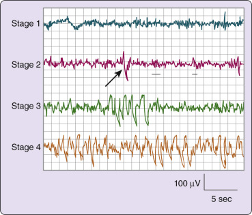 Sleep Related Breathing Disorders Pocket Dentistry