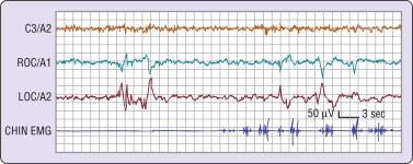 Sleep Related Breathing Disorders Pocket Dentistry