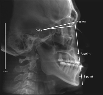 Pharyngeal Airway Evaluation After Isolated Mandibular Setback Surgery