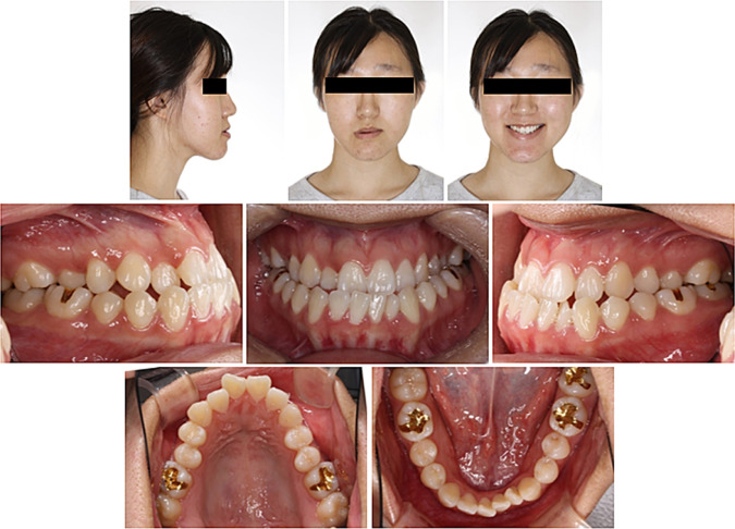 Team Approach For Orthognathic Surgery Pocket Dentistry