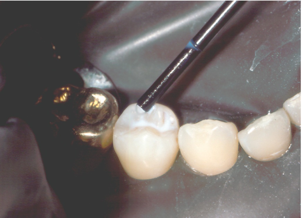 Pit And Fissure Sealants Pocket Dentistry