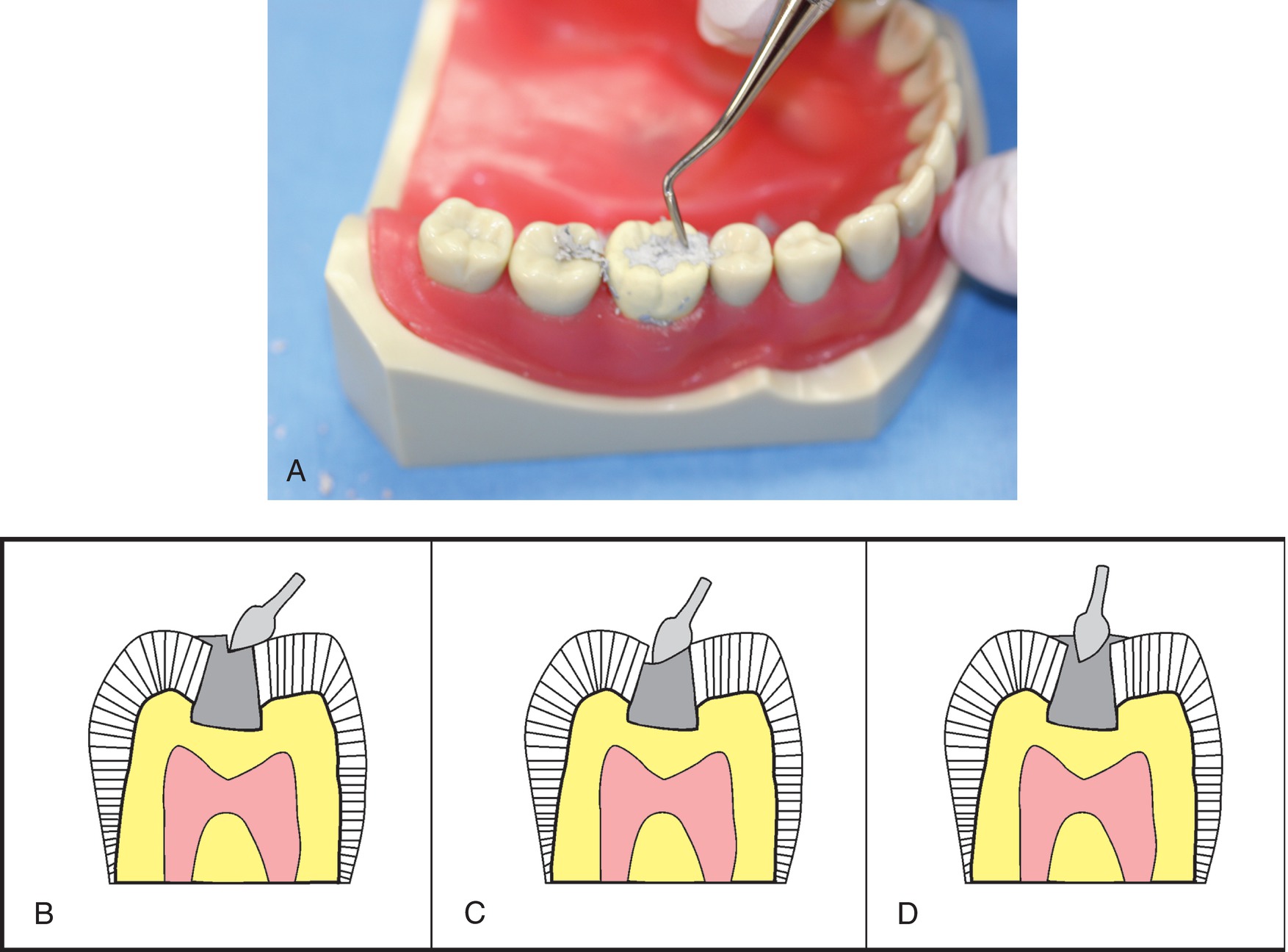 Amalgam Procedure Step By Step Amalgam Restoration Vjnt