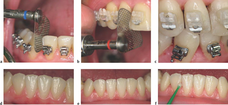 Interproximal Enamel Reduction Stripping Pocket Dentistry