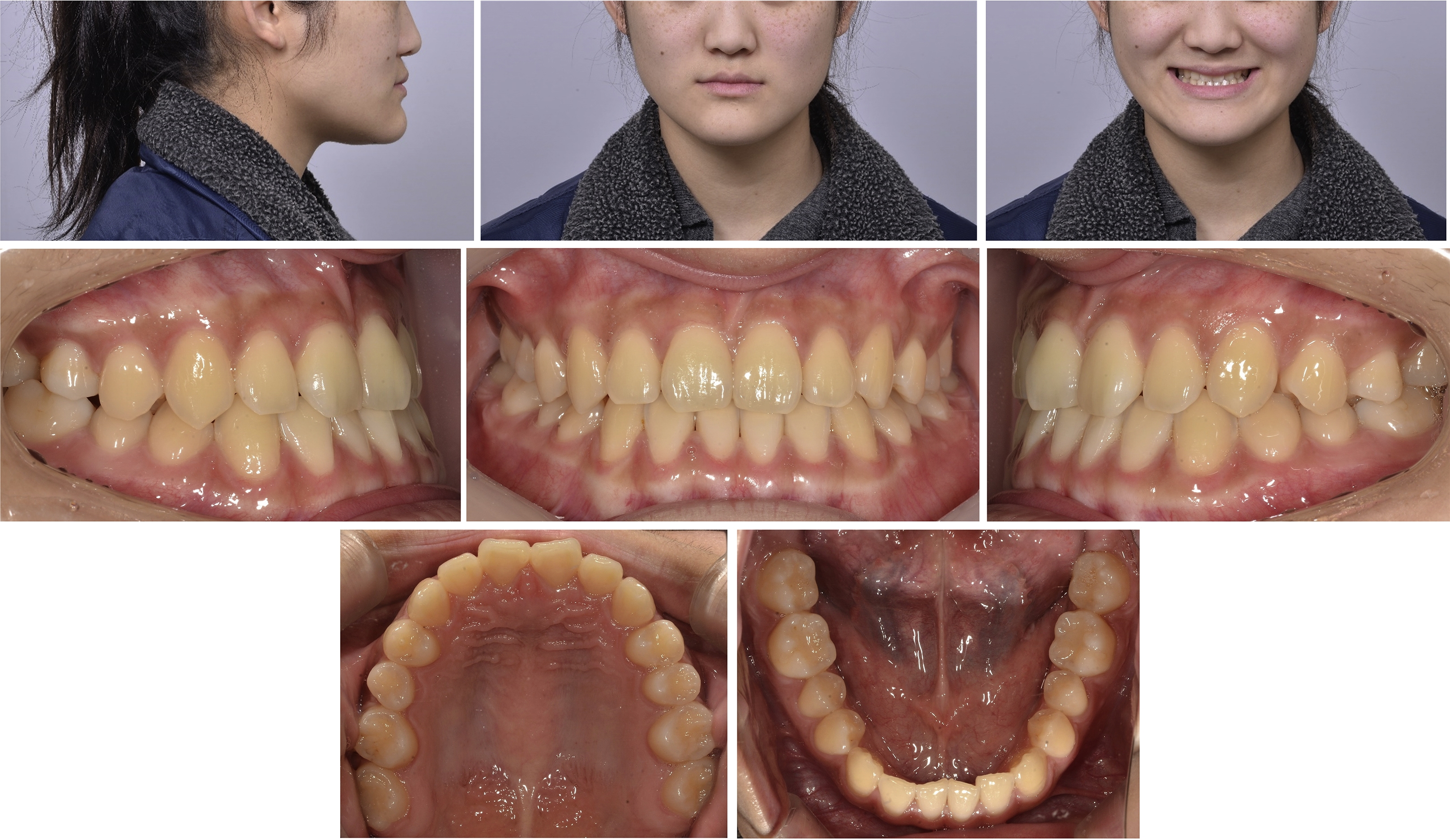 A Surgery First Approach Using Single Jaw Rotational Mandibular Setback