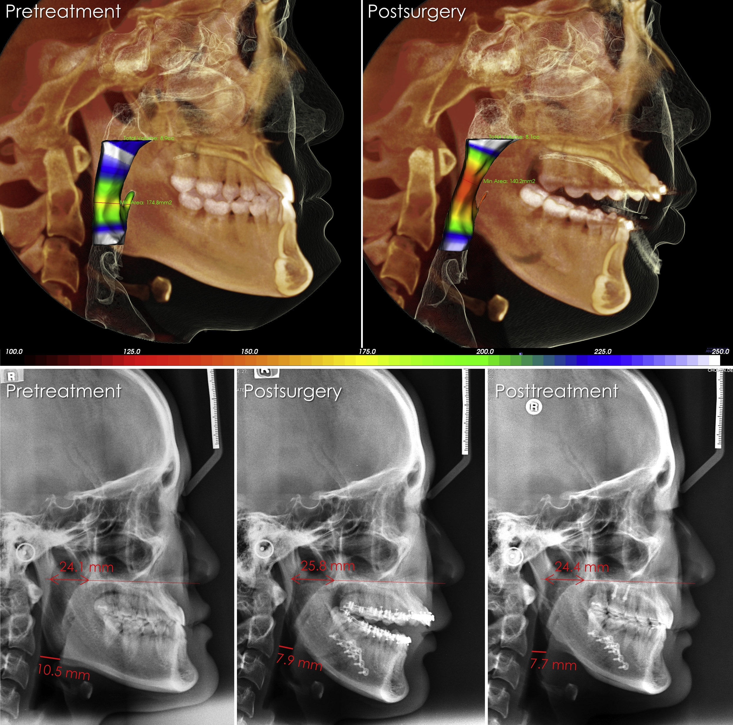 A Surgery First Approach Using Single Jaw Rotational Mandibular Setback