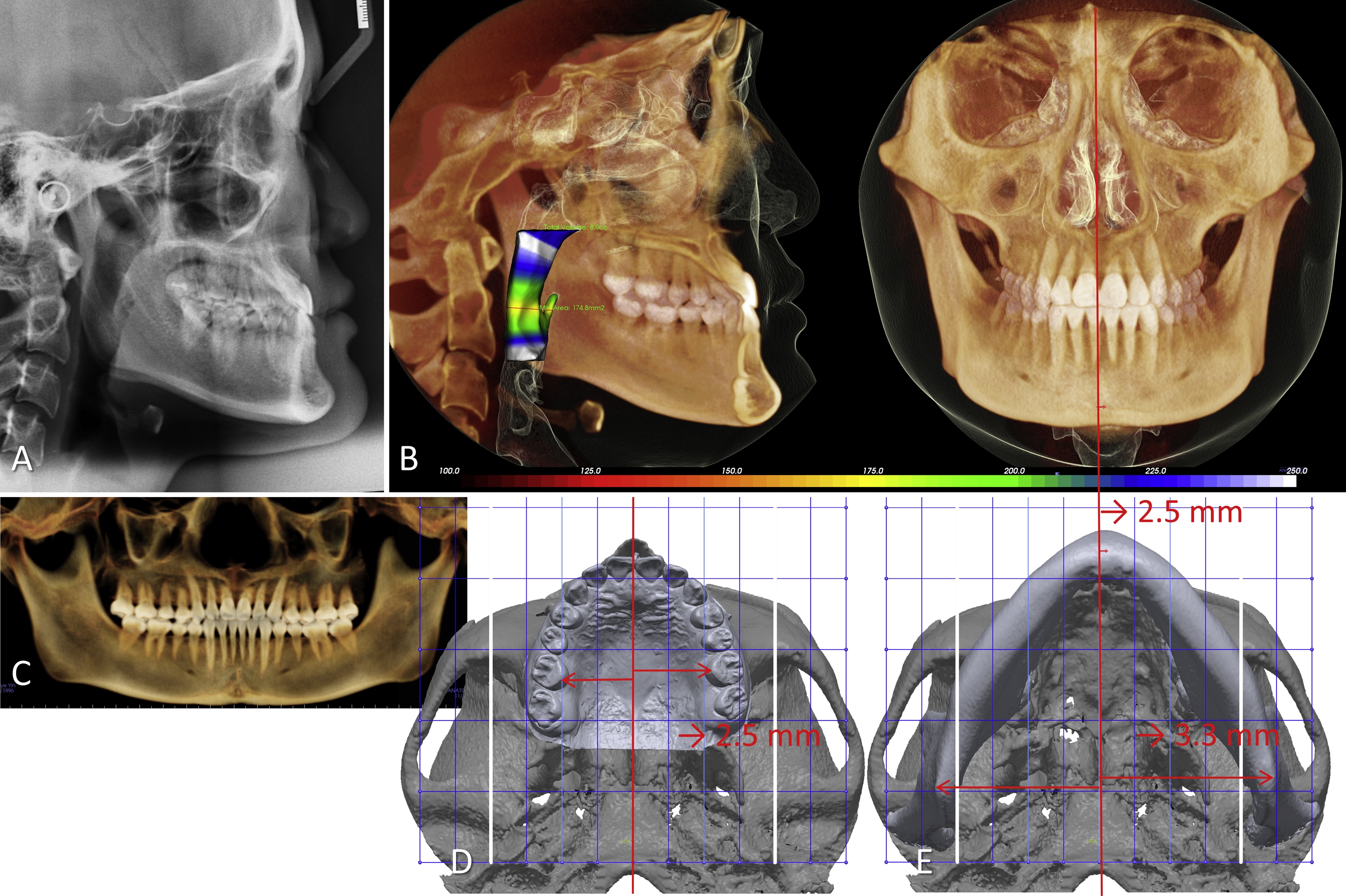 A Surgery First Approach Using Single Jaw Rotational Mandibular Setback