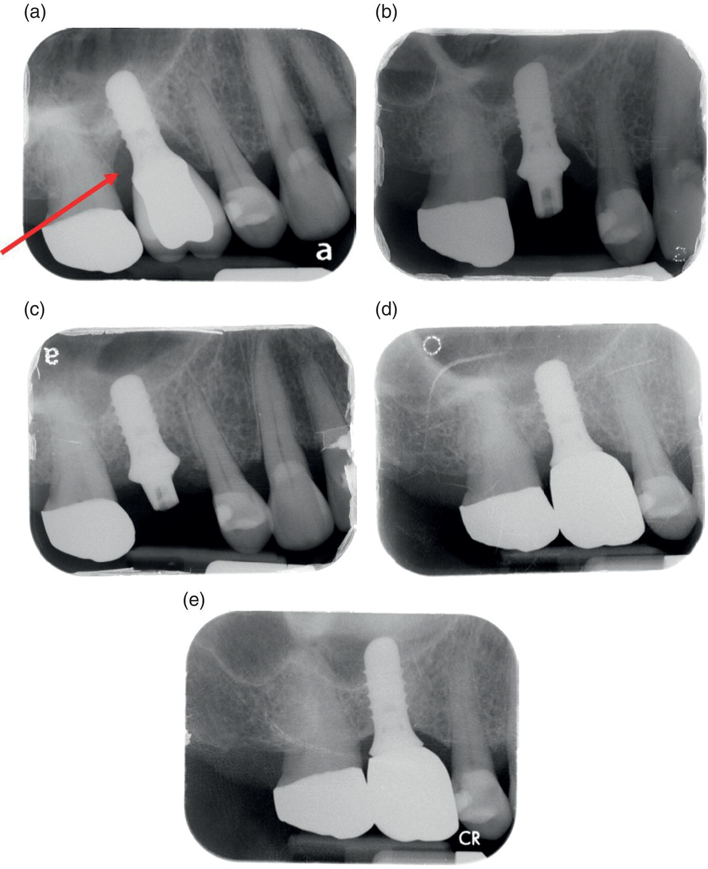 Dental Implant Failures Pocket Dentistry