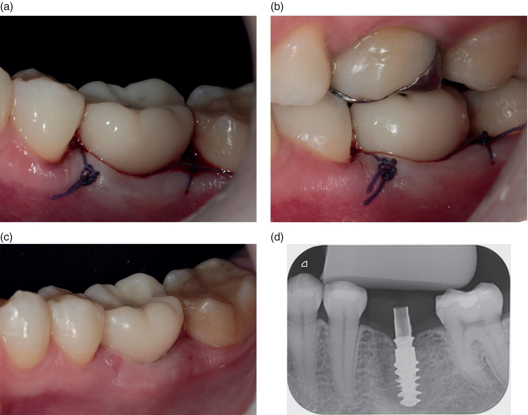 Digital Workflow In Implant Dentistry Pocket Dentistry