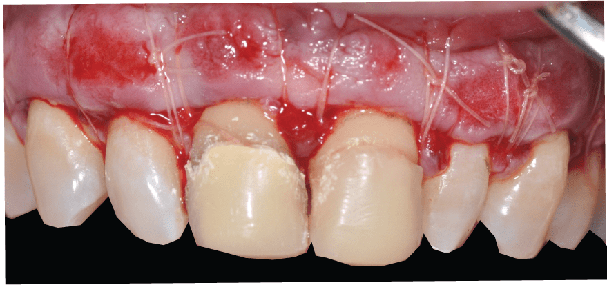 Suturing Techniques Pocket Dentistry