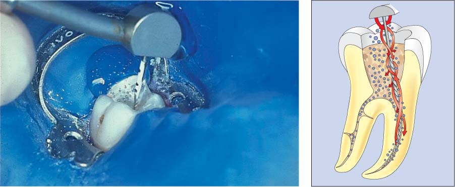 25 Root Canal Disinfection | Pocket Dentistry