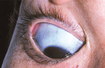 Osteogenesis Imperfecta Blue Sclera