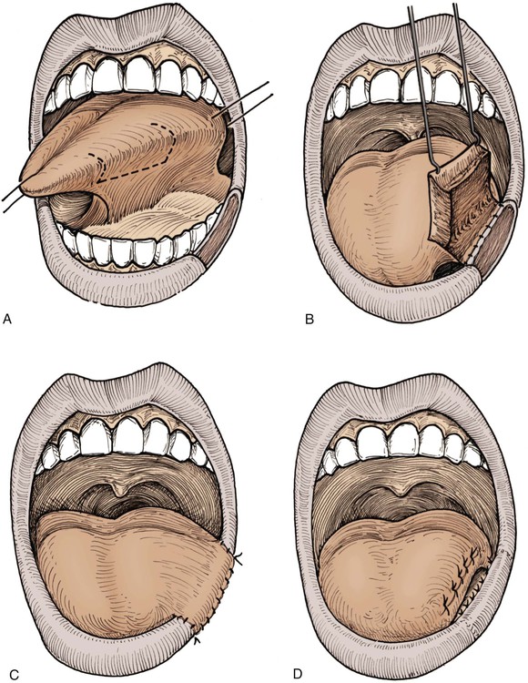 19: Reconstruction of the Lips | Pocket Dentistry