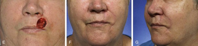 19: Reconstruction of the Lips | Pocket Dentistry