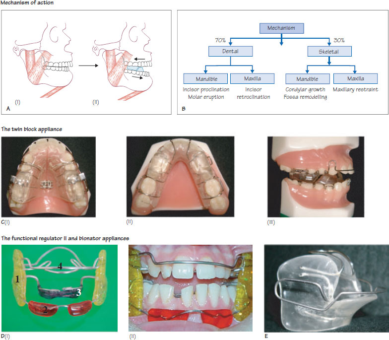 39 Functional Appliances Pocket Dentistry 39 Functional Appliances Pocket Dentistry